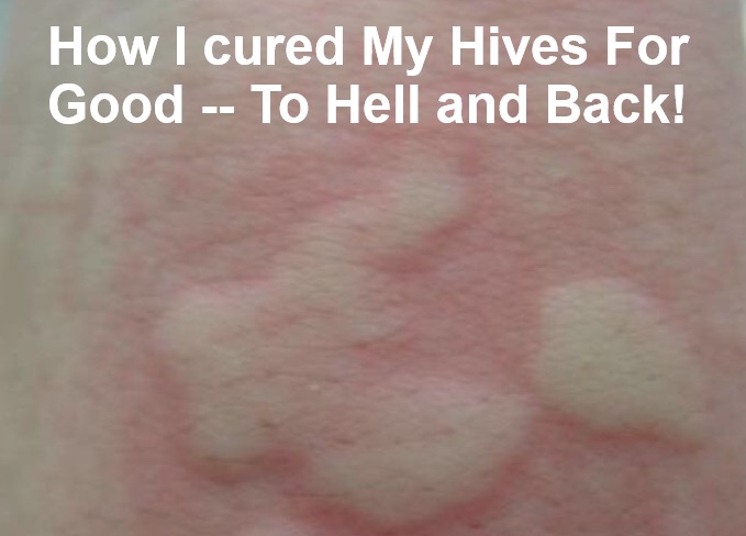 How I cured My Hives For Good (To Hell and Back) - Helping Freedom Win